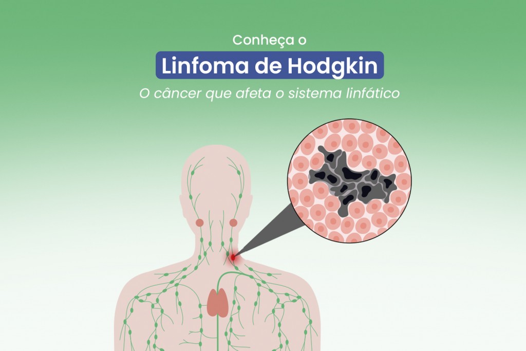 Linfoma de Hodgkin: Sintomas, Causas e Tratamentos - Hospital Santa Virgínia